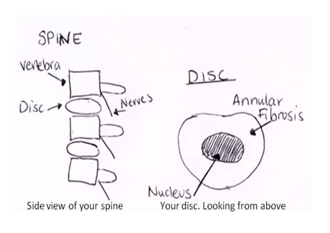 Disc Injuries Annular Tears Disc Bulges Disc Prolapse What Are The