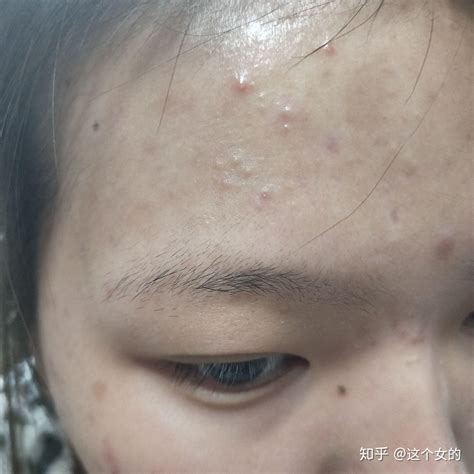 8年中度痘肌抗痘之路 主要服用异维A酸持续记录更新中 知乎