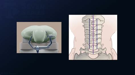 167 Orbitozygomatic Craniotomy For Resection Of A Lateral Frontal Arteriovenous Malformation