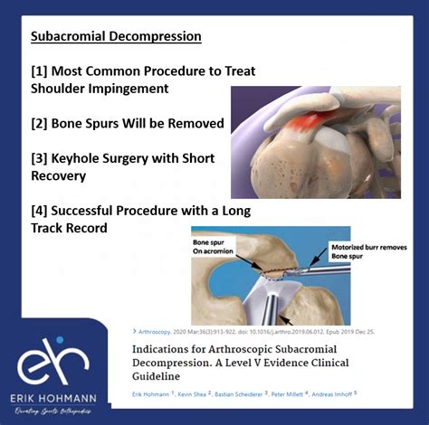 Subacromial Decompression Dr Hohmann Consultant Orthopedic And