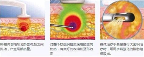 光纤溶脂是怎么做的？有哪些优势？术后护理事项怎么做？ 三元整形网