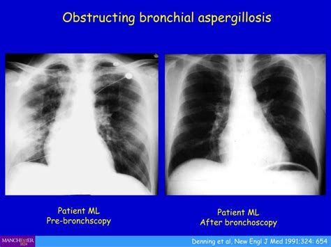 Ppt Aspergillosis In Aids Powerpoint Presentation Free Download Id