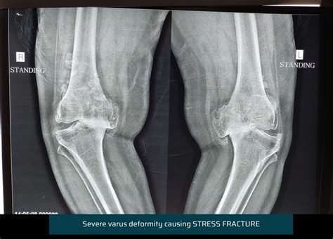 Complex Primary Total Knee Replacement Surgery Dr Rachit Sheth