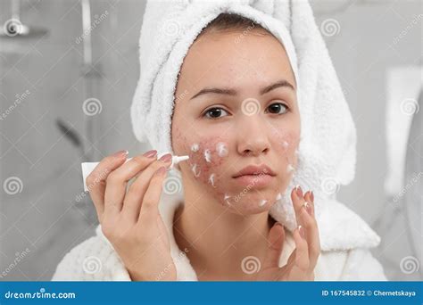 Teen Girl With Acne Problem Applying Cream Stock Photo Image Of Girl Indoors