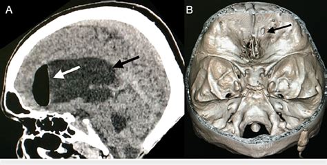 Computed Tomography A Ct Scan Of Skull Sagittal Showing Download Scientific Diagram