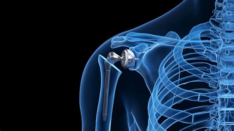 Computer Assisted Navigation Is Safe And Effective For Tsa Nyu Langone