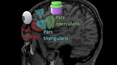 Neuroradiology Threads By Lea Alhilali Brocas Area