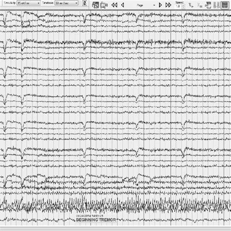 Eeg Artifact Eeg Recording Showing Tremor Artifact In Midline And