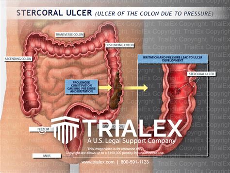 Stercoral Ulcer Trialexhibits Inc