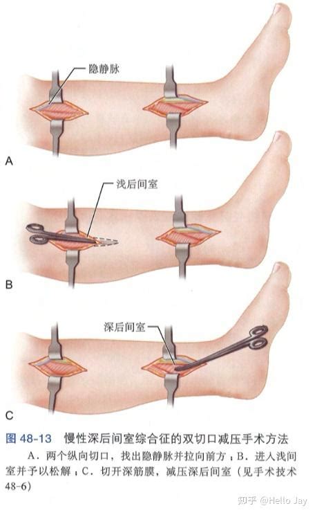 骨筋膜室综合征 知乎