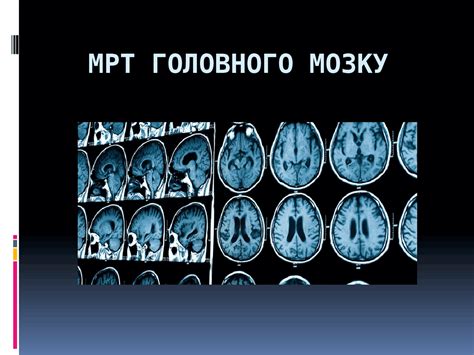 МРТ головного мозку презентація Docsity
