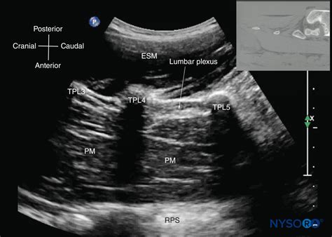 A Spinal Cord Ultrasonography In A Longitudinal Section