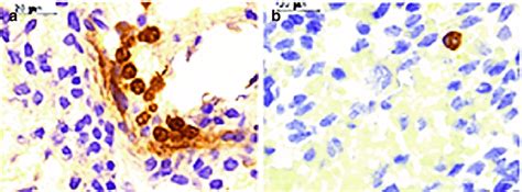 4 Expression Of Neutrophil Specific Cd16b Mrna In Hhv 6 Positive