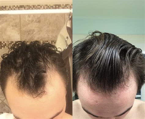 Finasteride Only Significant Results Rtressless