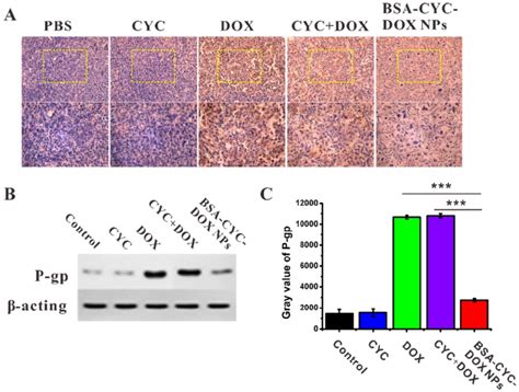 Expression Of P Glycoprotein In Tumor Tissues And Tumor Cells After
