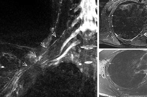Eduardo Bizetto On Linkedin Mri Neurography Nerve Msk Radiology