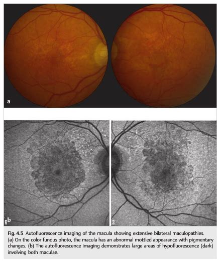 Neuro Ophthalmology Question Of The Week Fundus Autofluorescence