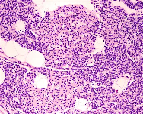 Diagnosing Mantle Cell Lymphoma