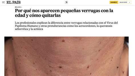 Por Qué Nos Aparecen Pequeñas Verrugas Con La Edad Y Cómo Quitarlas