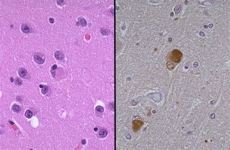 Cns Pathology