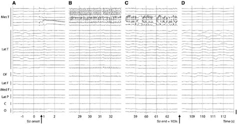 Example Intracranial Eeg Recording During A Temporal Lobe Download Scientific Diagram