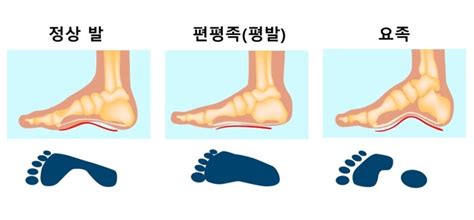 발등 통증 발바닥 통증의 원인은 요족 평발 족저근막염 족궁 발의 아치 네이버 블로그