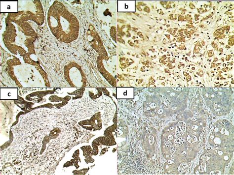 Sections Of Crc Immunostained By β Catenin A Case Of Well Moderately