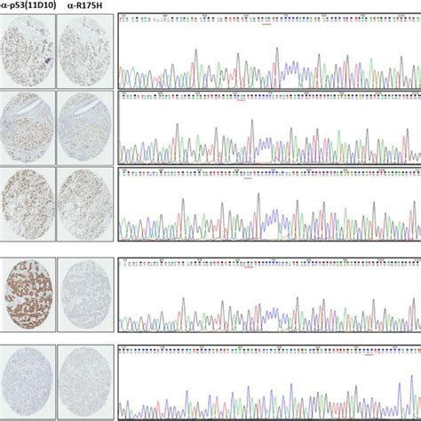 Analysis Of Human Tumor Microarrays With Mutant P53 Specifc Mabs