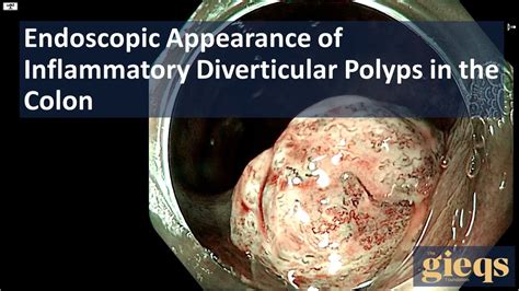 Endoscopic Appearance Of Inflammatory Diverticular Polyps In The Colon Youtube