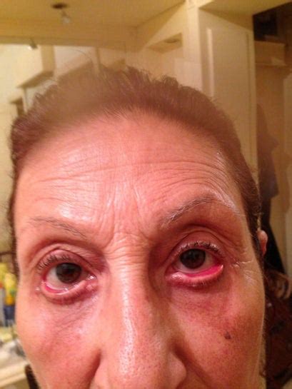 Ectropion After Lower Blepharoplasty