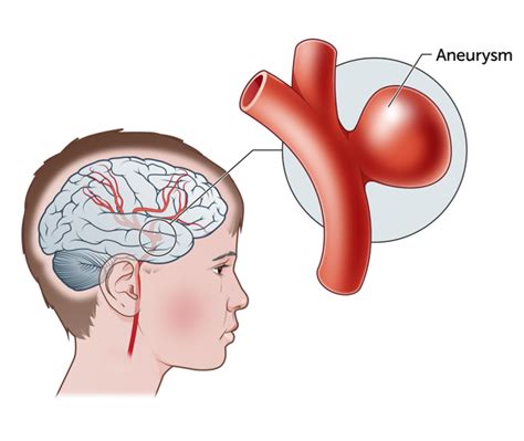 Anevrism cerebral simptome cauze și tratament MedStore
