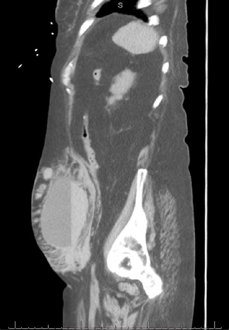 Computed Tomography CT Scan Sagittal Section Demonstrating A X Download Scientific