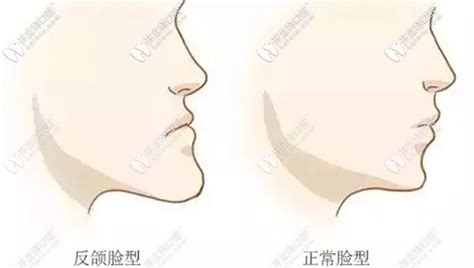 反颌的脸型图片儿童儿童反颌的脸型图片反颌的脸型图片第3页大山谷图库