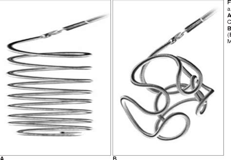 Figure 1 From Endovascular Management Of The Wide Neck Aneurysms The