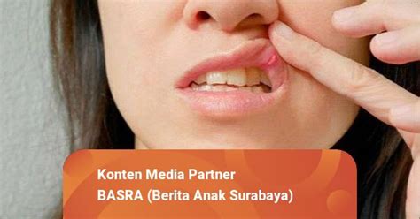 Sariawan Tak Kunjung Sembuh Waspada Kanker Kepala Dan Leher Kumparan