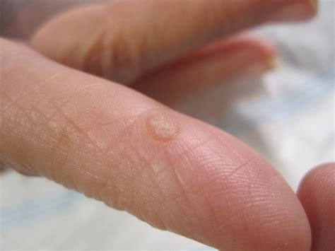 Clinical Manifestations Of The Human Papillomavirus Intechopen