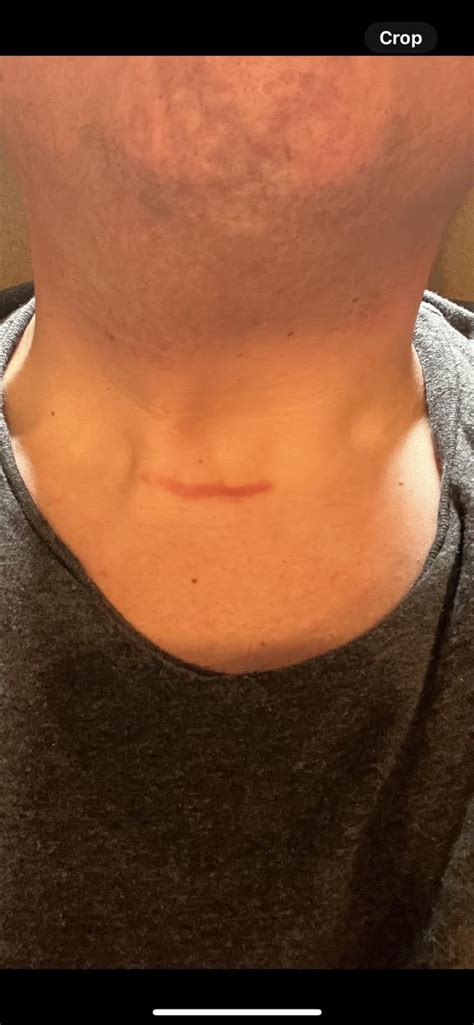 Parathyroid Scar Rmedical