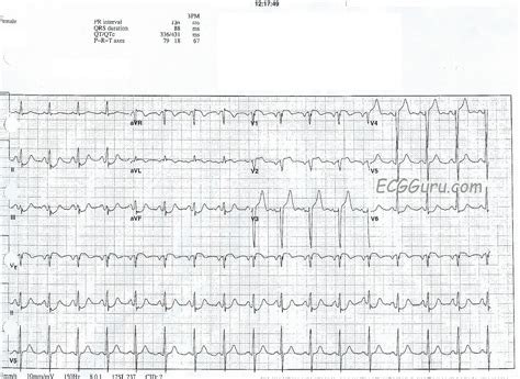 Anterior Wall Mi Ecg Guru Instructor Resources