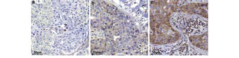 Numb Expression In Primary Breast Cancers Examples Of A Deficient