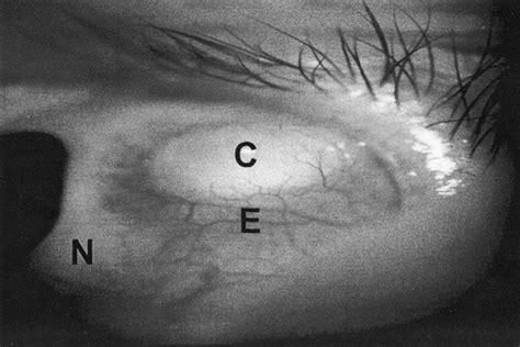 Conjunctival Vascularity Was Scored For Three Separate Zones The