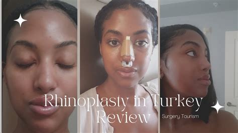 Rhinoplasty In Turkey Review Youtube