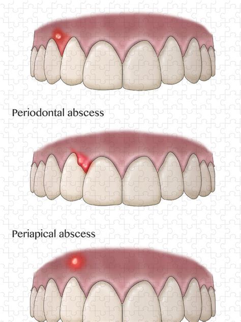 Types Of Dental Abscess Kr
