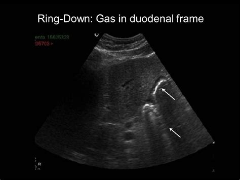 Figure 7 From Ring Down Versus Comet Tail Two Artifacts Uncovered
