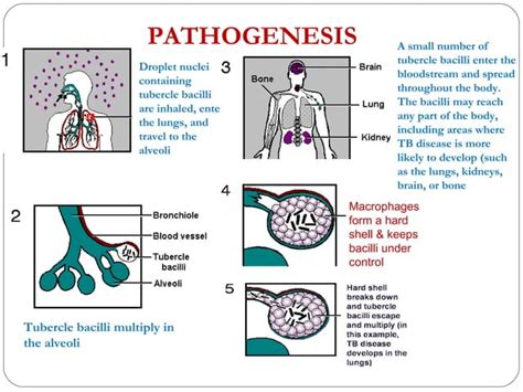 Hiv And Tb Coinfection