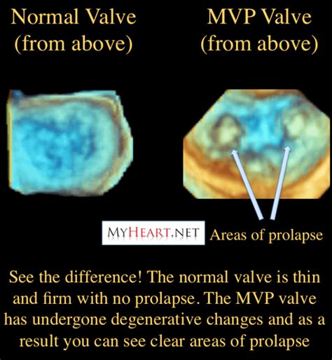 Understanding Mitral Valve Prolapse