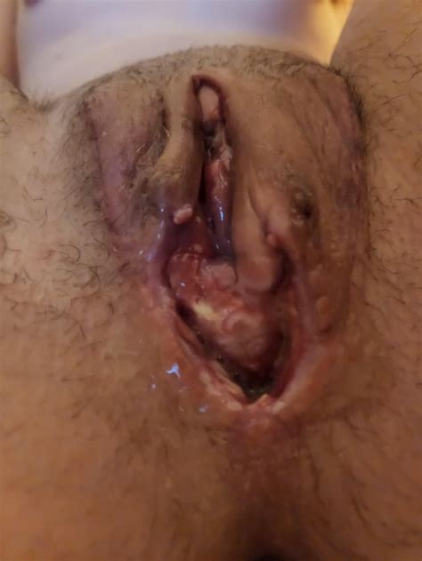 Mtf Bottom Surgery Its Been A Journey And Ive Still Got A Ways To Go