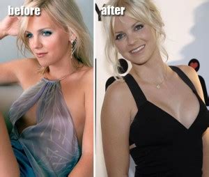 Anna Faris Before And After Plastic Surgery Health Information
