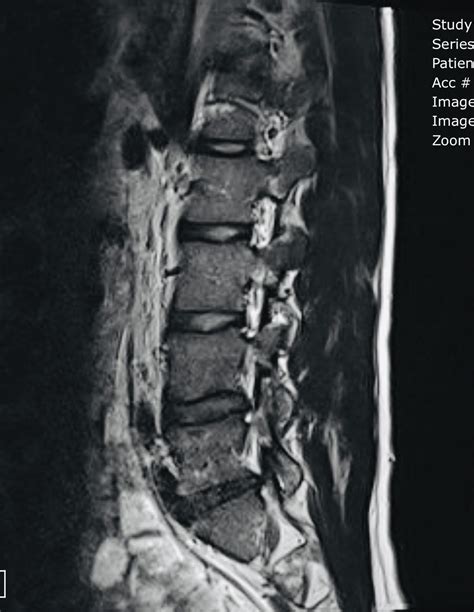 Spine Specialist Recommending Laminectomy And Fusion L4l5s1 Rsciatica