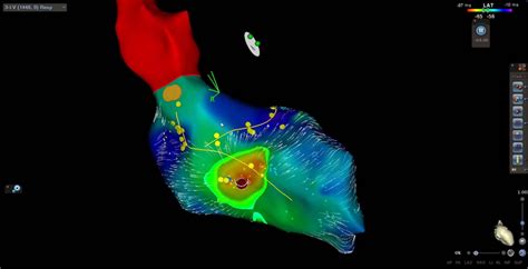 Carto 3d Mapping System Picture Of Ectopic Focus In The Left Ventricle Download Scientific