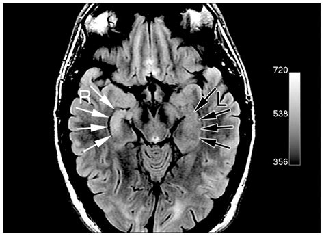 Medial Temporal Lobe Mri